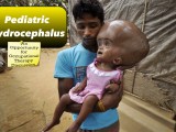 Hydrocephalus In Children