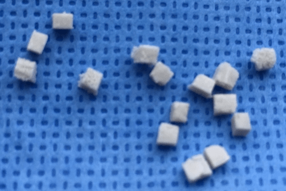 A Novel Bone Void Filler for Use in Prosthetic Joint Infections ...