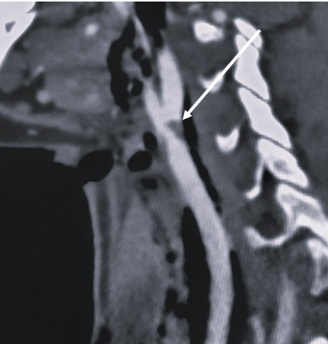 Successful Surgical Management of a Traumatic Dissection of Internal ...