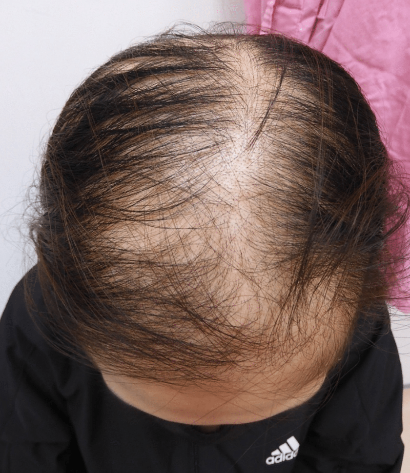 Diffuse Alopecia Areata and Its Trichoscopic Findings Following COVID ...