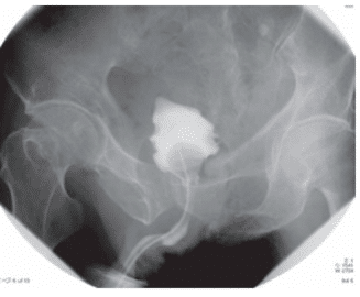 Bladder Explosion during Transurethral Resection Surgery-Case Series ...