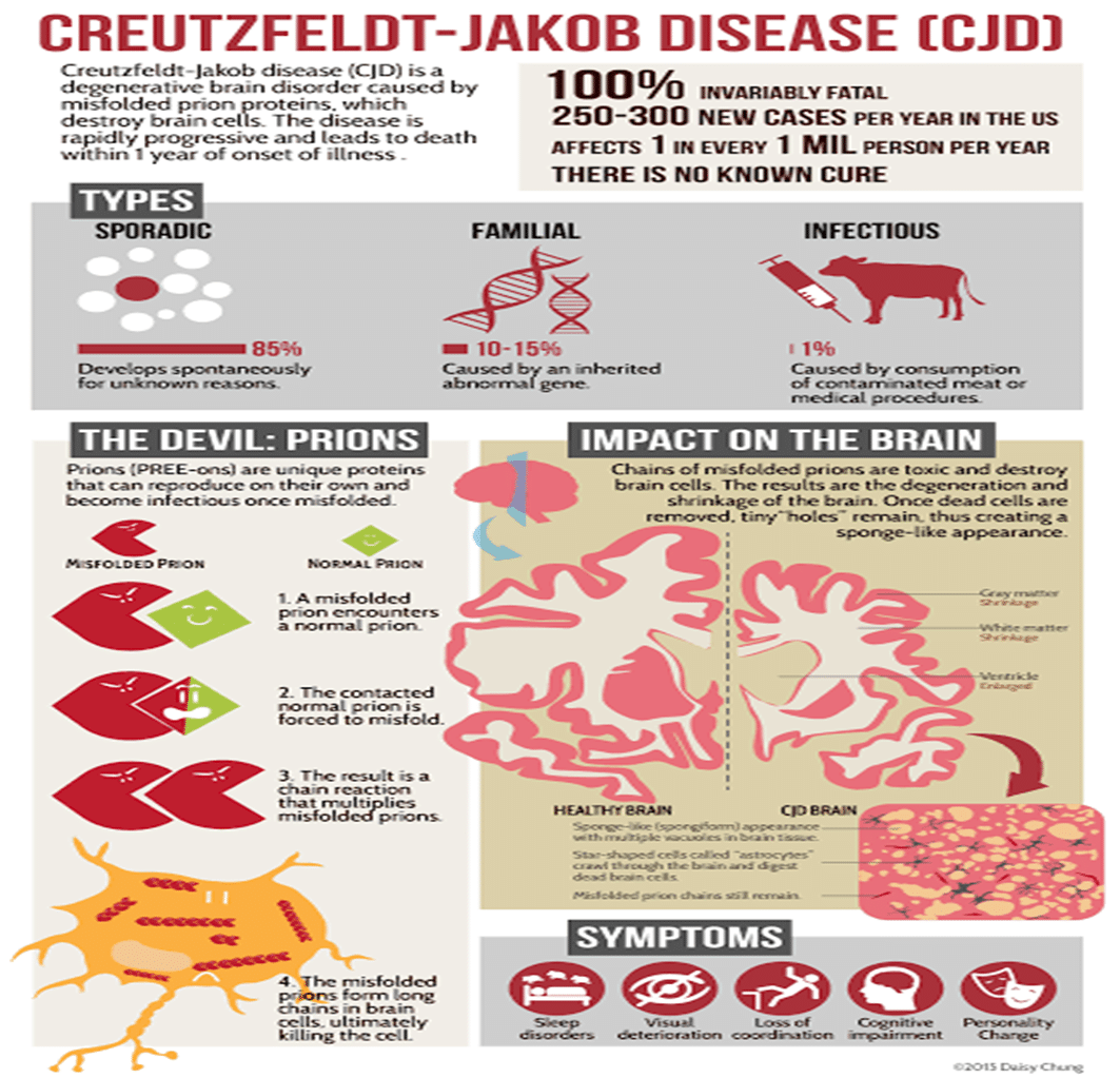Human CO Model of Creutzfeldt - Jakob Disease (CJD) Evaluates the ...