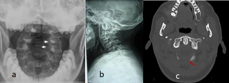 Distinctive Skeletal Phenotype in Patients with Kniest Dysplasia ...