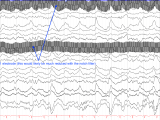Bme Eeg Analysis Preprocessing Aursus