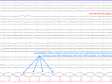 Bme Eeg Analysis Preprocessing Aursus