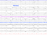 Bme Eeg Analysis Preprocessing Aursus