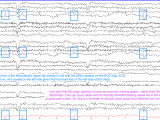 Bme Eeg Analysis Preprocessing Aursus