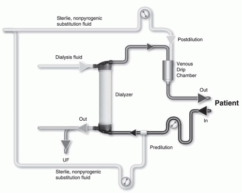 Hemodiafiltration | Basicmedical Key