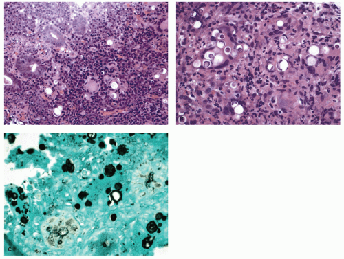 Enteric Infections and Associated Diseases | Basicmedical Key