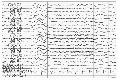 Types of Seizures | Basicmedical Key
