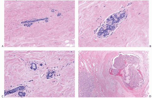 Abnormalities of Mammary Development and Growth | Basicmedical Key