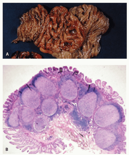 Lymphoproliferative Disorders of the Gastrointestinal Tract ...