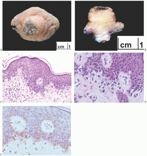 Cutaneous Neoplasms | Basicmedical Key