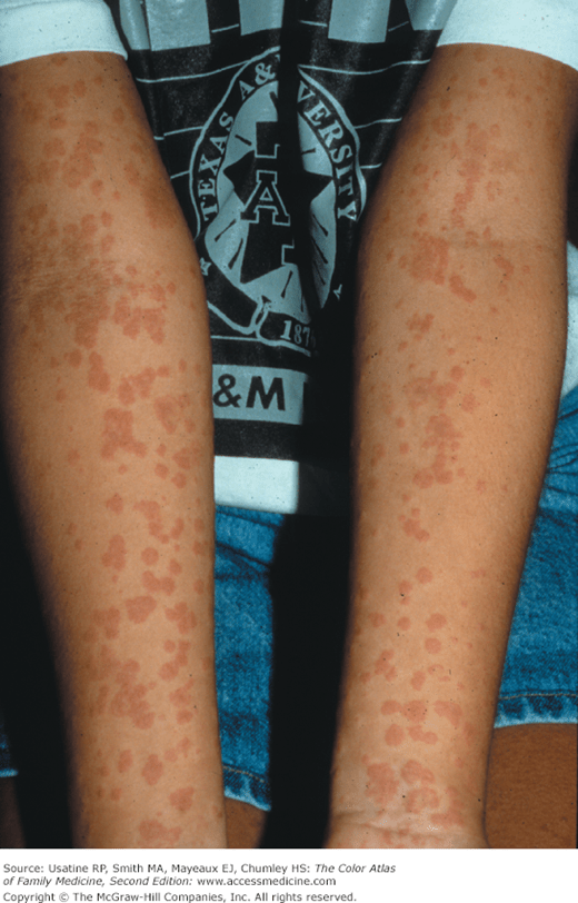 Herald patch pityriasis rosea causes - bridalnsa