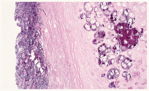 Complications Involving the Anastomosis | Basicmedical Key