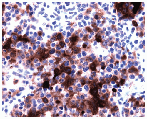 Post-Transplant Lymphoproliferative Disorders | Basicmedical Key