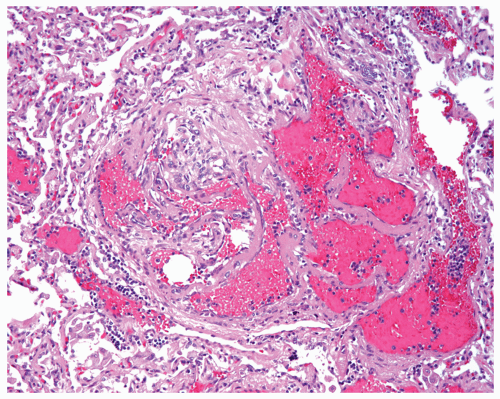 Phen-fen | Basicmedical Key