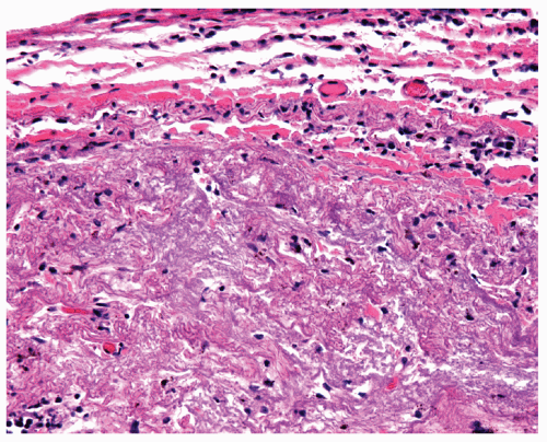Apical Scars | Basicmedical Key