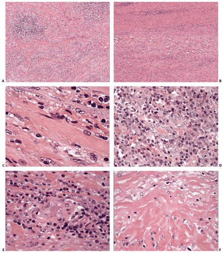 Thyroiditis | Basicmedical Key