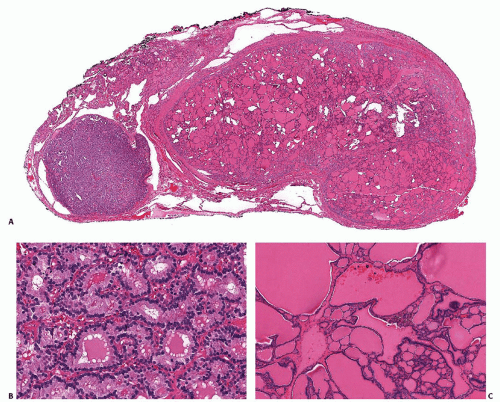 Diffuse and Nodular Hyperplasia | Basicmedical Key