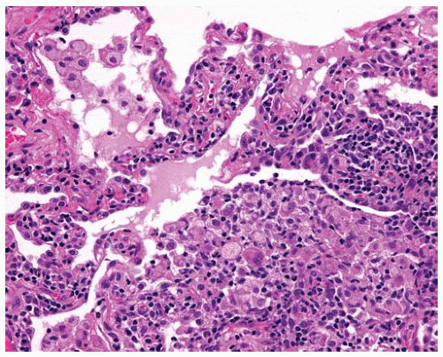 Bronchiolar and Peribronchiolar Inflammation, Fibrosis, and Metaplasia ...