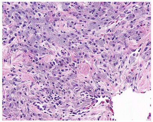 Fibrinous and Fibrous Pleuritis | Basicmedical Key