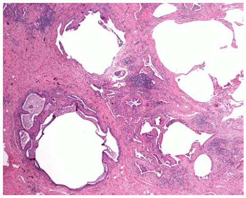 Usual Interstitial Pneumonia | Basicmedical Key