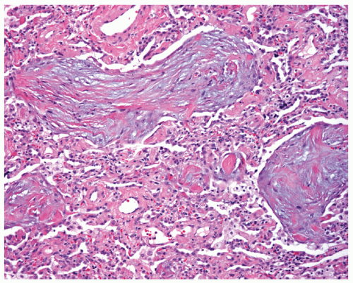 Mycoplasma | Basicmedical Key