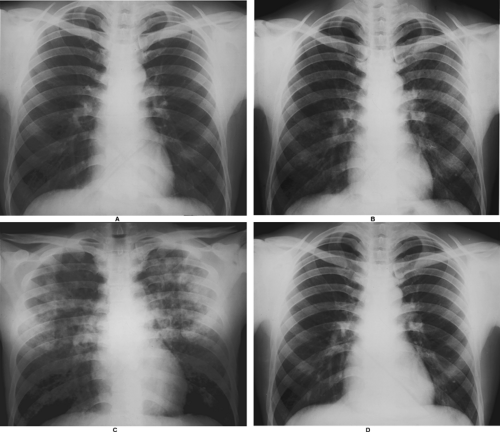 Phosgene and Toxic Gases | Basicmedical Key