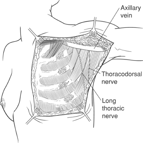 Mastectomy: Total (Simple), Modified, and Classic Radical ...