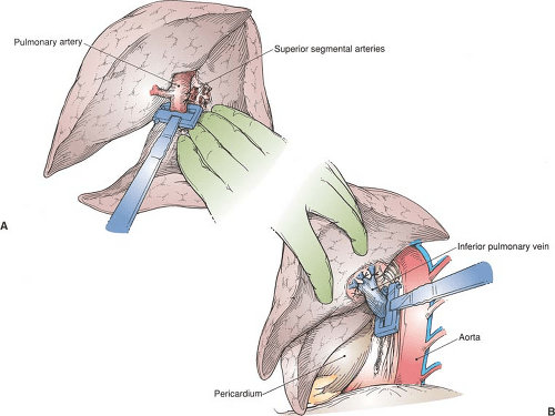 Lobectomy | Basicmedical Key