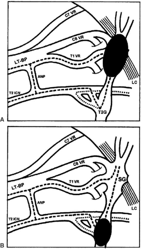 Thoracoscopic Sympathectomy and Splanchnicectomy | Basicmedical Key