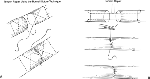 Tendon Repair | Basicmedical Key