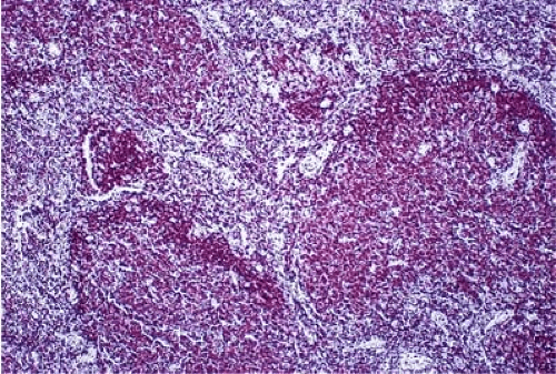 Atypical Lymphoid Hyperplasia | Basicmedical Key
