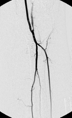 Femoral to Popliteal Bypass | Basicmedical Key