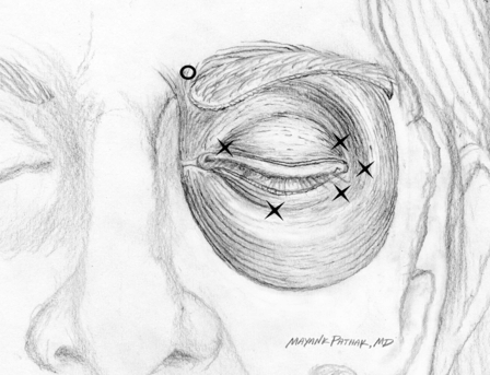 Treatment of blepharospasm | Basicmedical Key