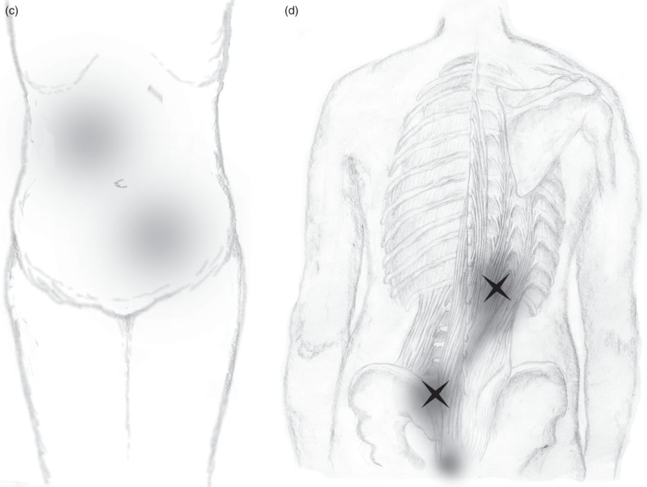 Use of botulinum neurotoxin in the treatment of low-back pain | Basicmedical Key