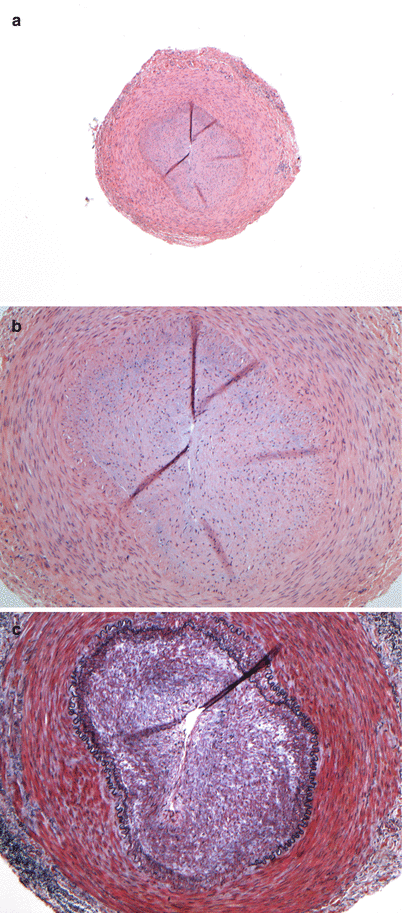 Vascularized Composite Tissue Transplant Pathology | Basicmedical Key