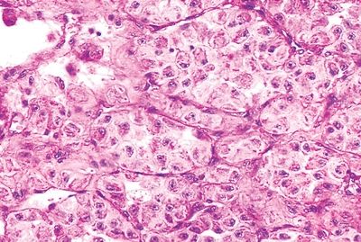 Disorders of Soft Tissue | Basicmedical Key