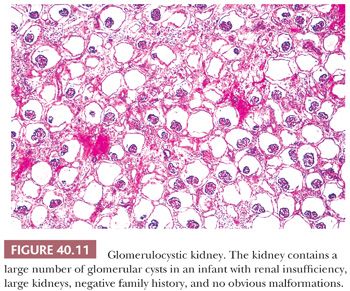 Developmental Abnormalities of the Kidney | Basicmedical Key