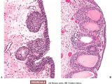 Urethral Caruncle Histology