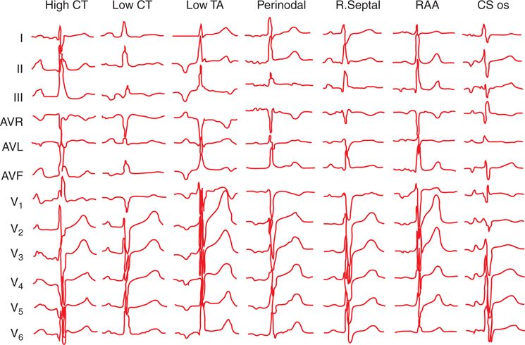 Atrial Tachycardia and Cardiac Anatomy: Crista Terminalis ...