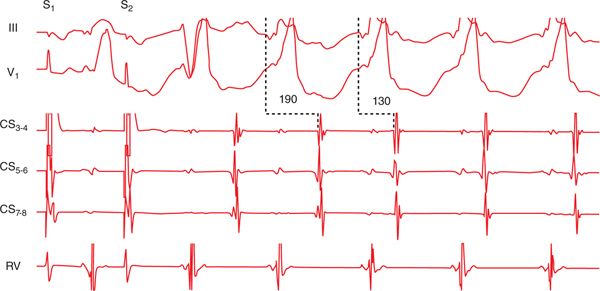 Atrioventricular Reciprocating Tachycardia: Right-Sided | Basicmedical Key