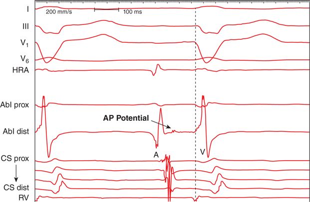 Atypical Accessory Pathways | Basicmedical Key