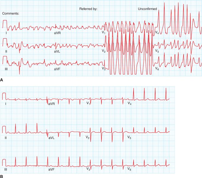Wolff-Parkinson-White Syndrome and Sudden Cardiac Death | Basicmedical Key