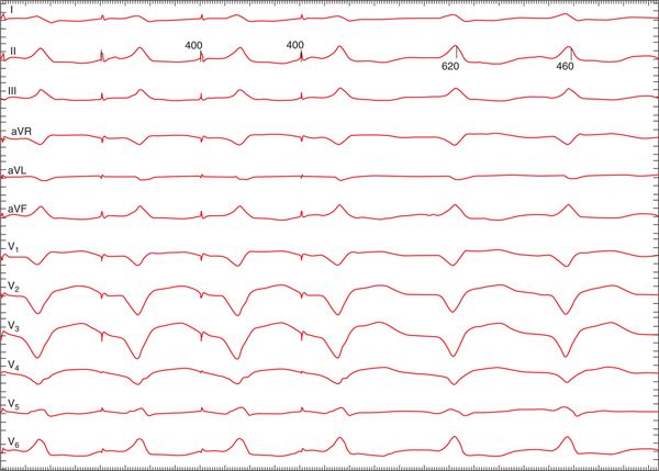 Patient with Ischemic Cardiomyopathy Presents with Sustained Stable ...