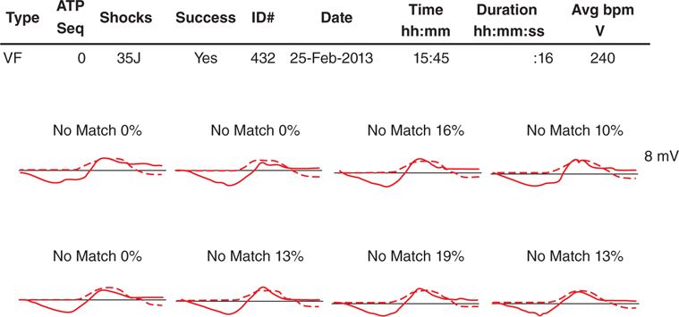 Managing Recurrent ICD Therapies: Medical Therapy | Basicmedical Key