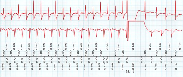 Device Troubleshooting: Case I—Diagnosis of SVT versus VT ...