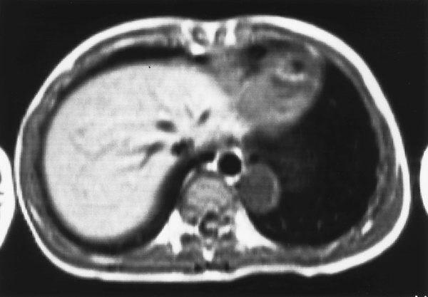 Pediatric Surgery | Basicmedical Key