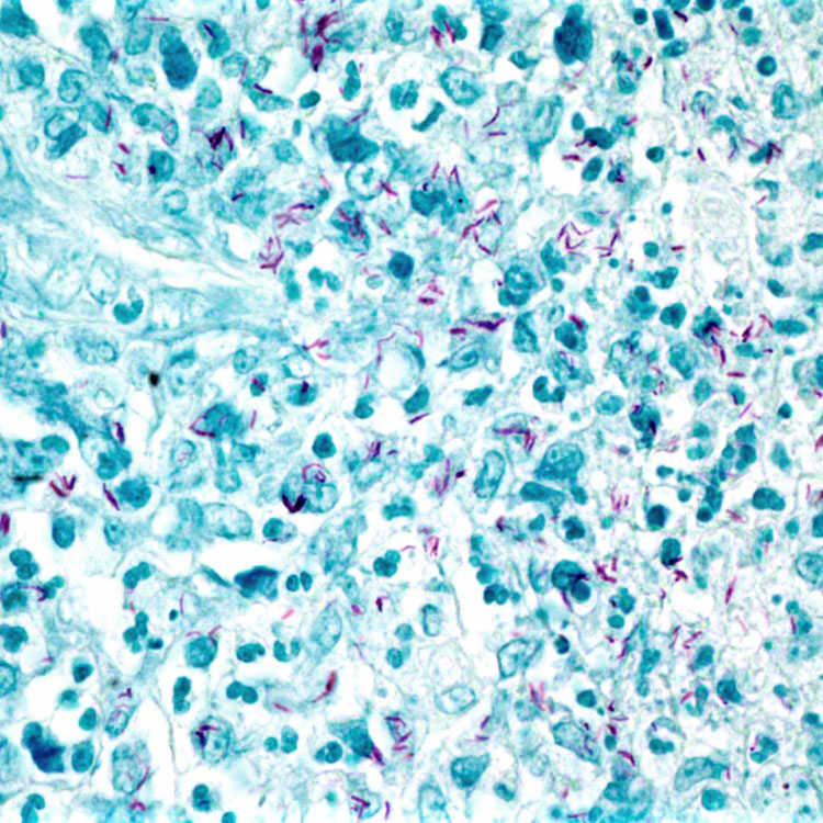 Infectious Pancreatitis | Basicmedical Key